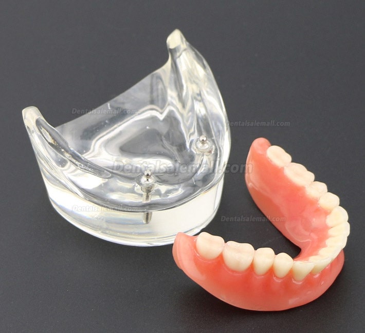Dental Teeth Model Overdenture Inferior with 2 Implants Study Demo ...