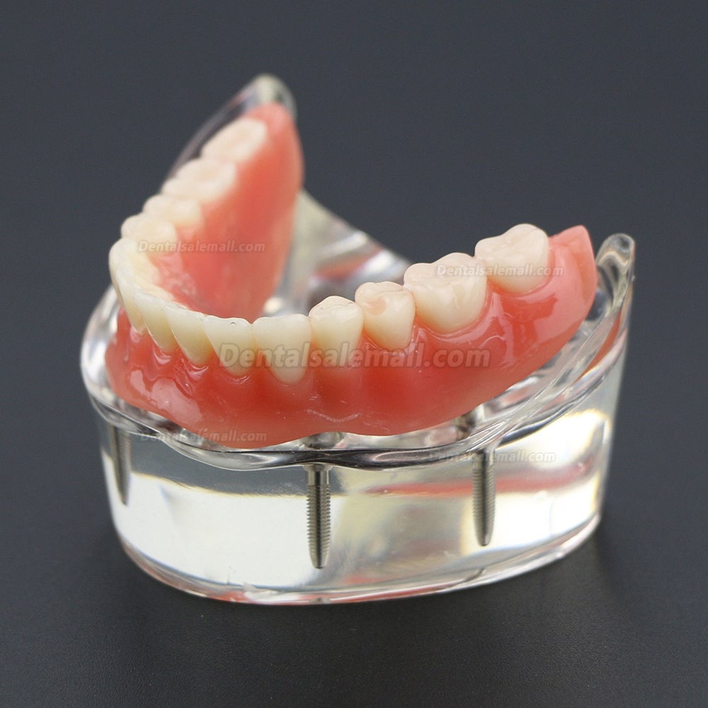 Dental Lower Teeth Demo Study Model 6002 02 Overdenture Inferior 4 ...