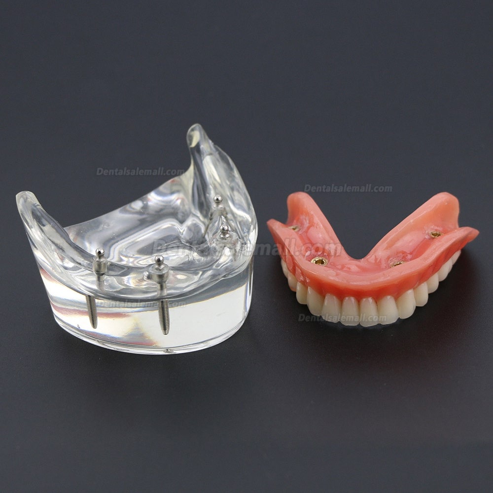 Dental Lower Teeth Demo Study Model 6002 02 Overdenture Inferior 4 ...